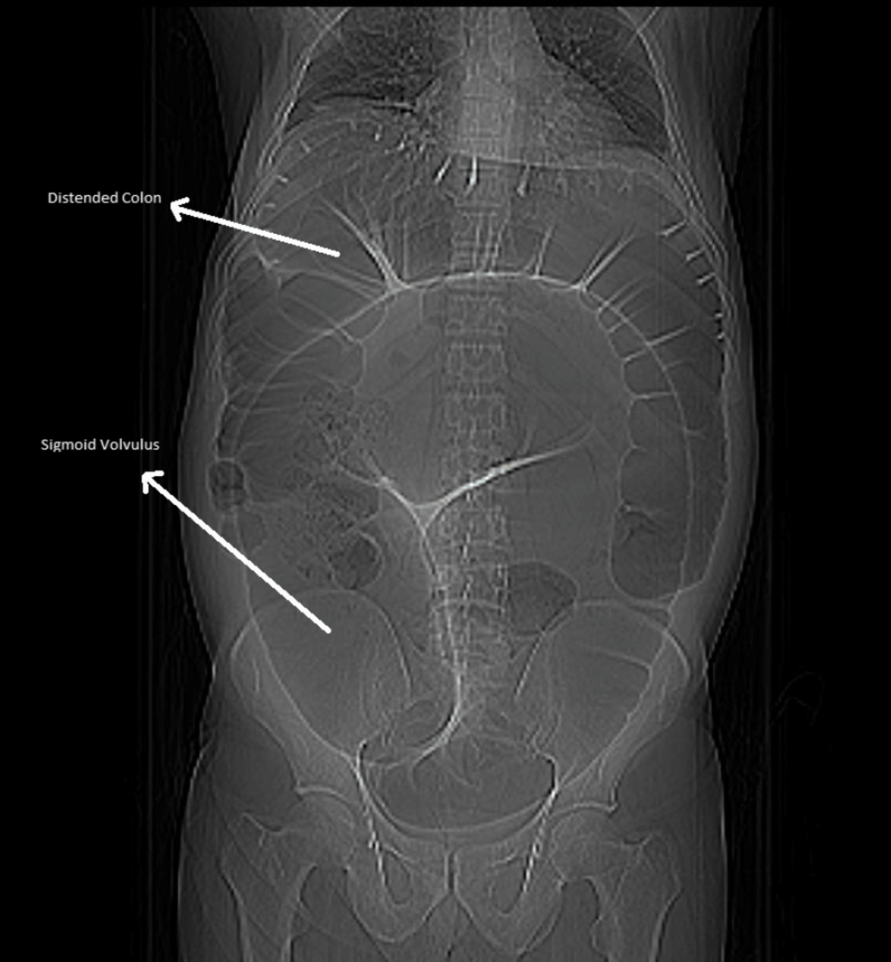 A Case Report of Chilaiditi’s Syndrome With Sigmoid Volvulus | Cureus