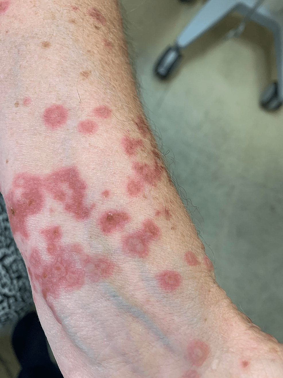Cureus Stevens Johnson Syndrome In A Patient With Recent SARS CoV 2 Cureus Stevens Johnson Syndrome In A Patient With Recent SARS CoV 2
