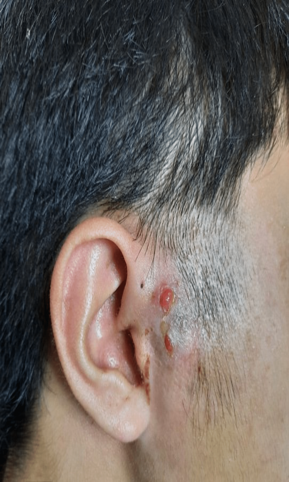 Mycobacterial Preauricular Sinus Abscess: A Case Series | Cureus