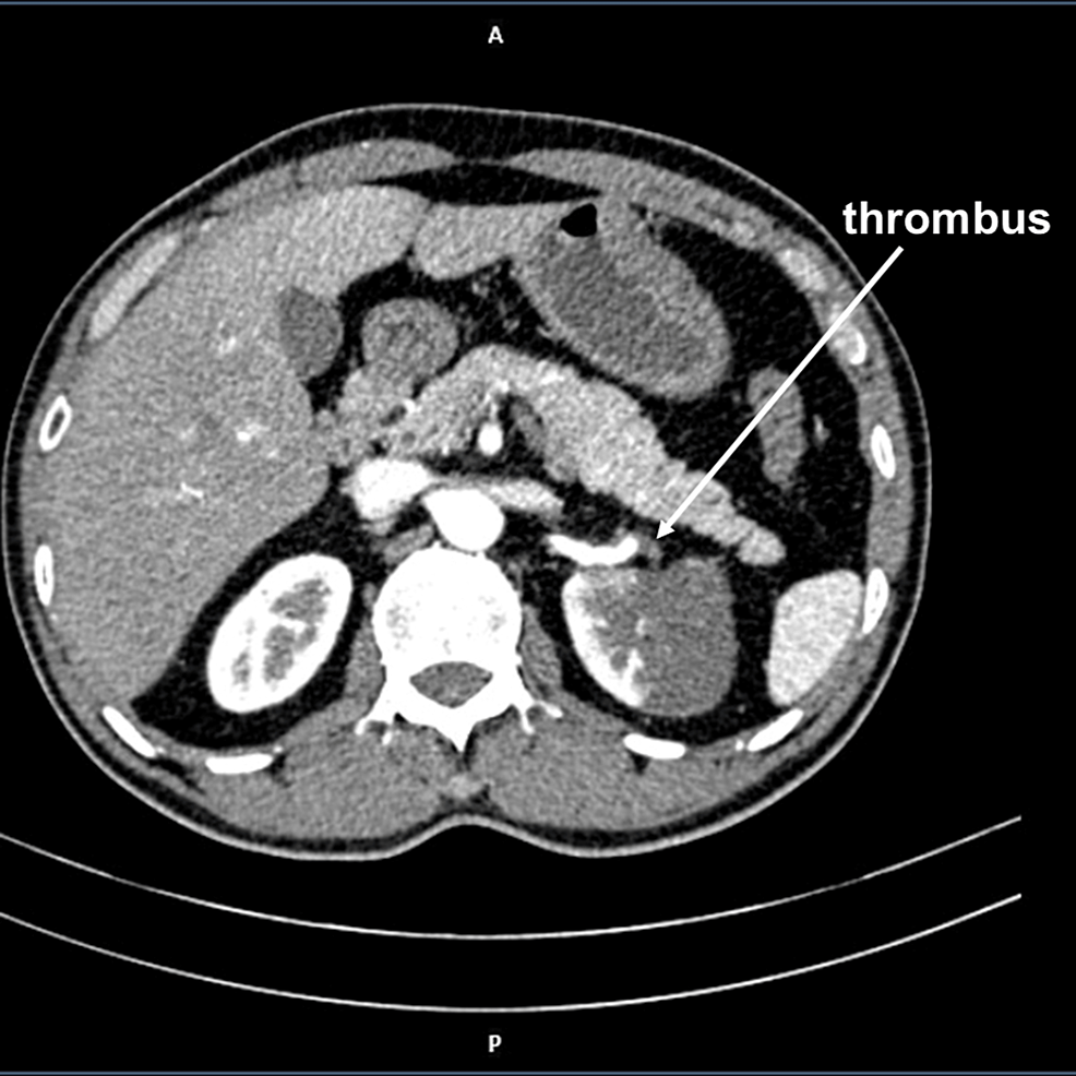 Cureus A Massive Renal Infarction Due To Atheroemboli A Case Report
