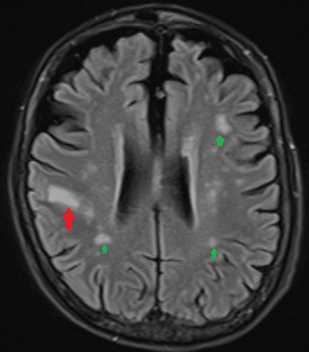 Cureus Misdiagnosed Progressive Multifocal Leukoencephalopathy PML Cureus Misdiagnosed Progressive Multifocal Leukoencephalopathy PML