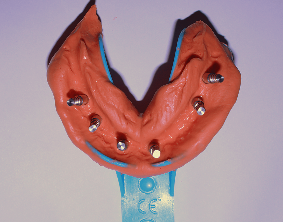Maxillary Cast Partial Denture and Mandibular Implant-Supported Metal ...