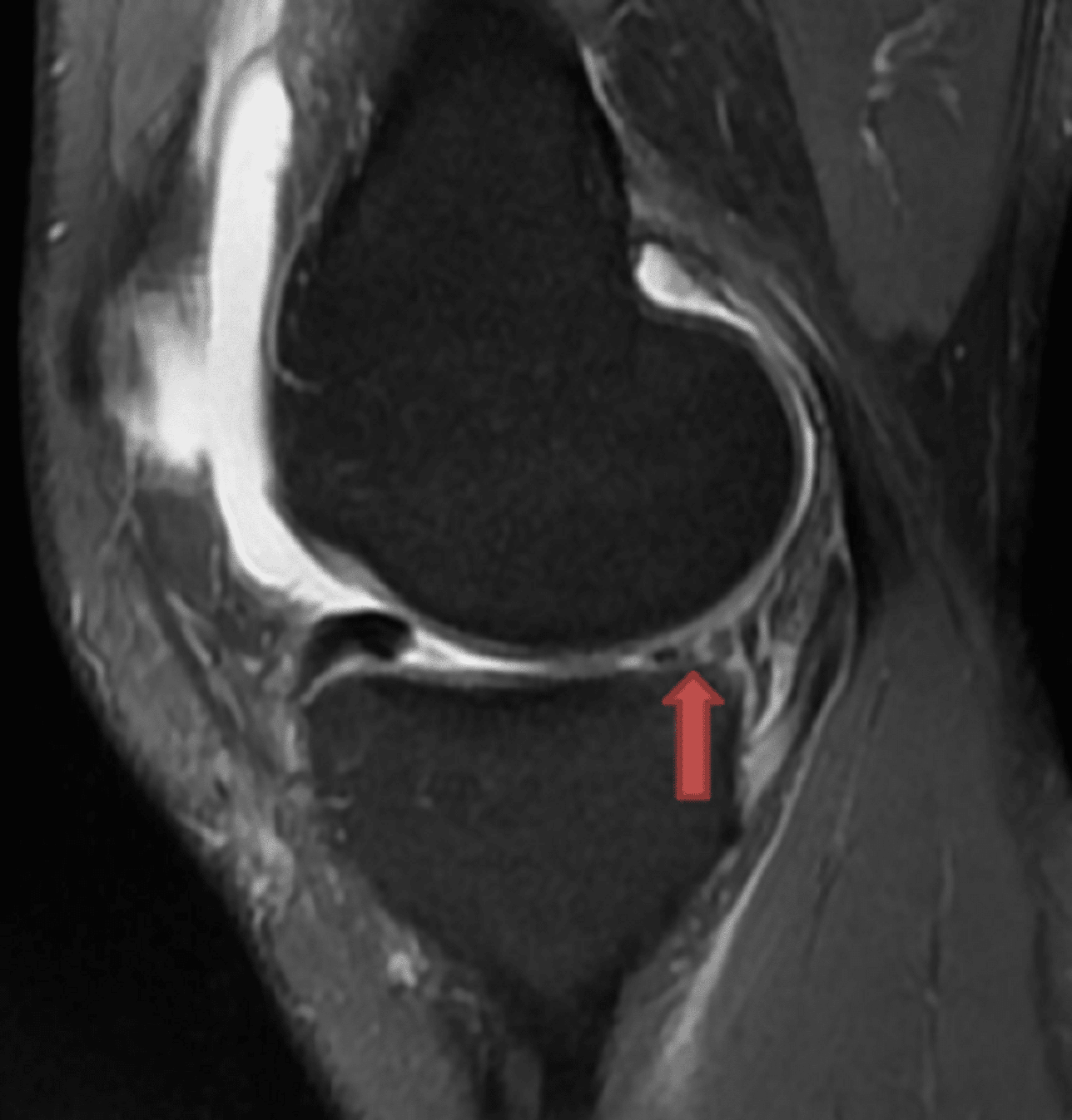 MRI in the Diagnosis of Bucket Handle Tears: What Is the Current ...