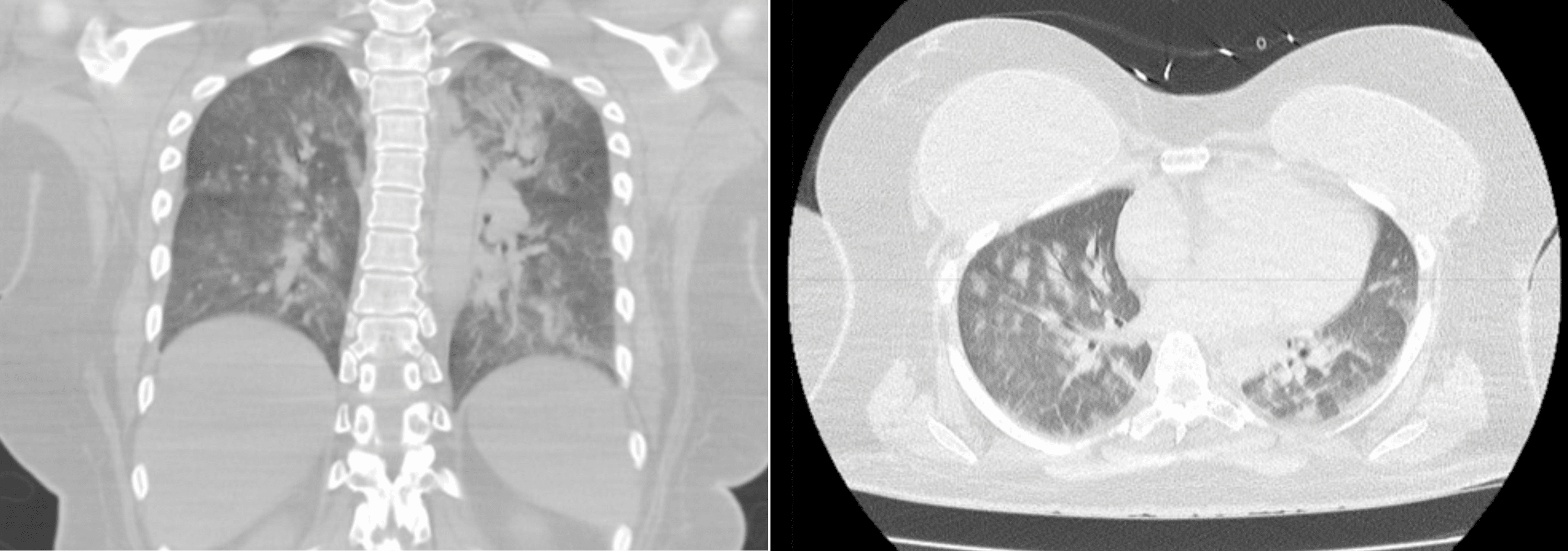 A Complex Presentation of Acute Postoperative Negative-Pressure ...