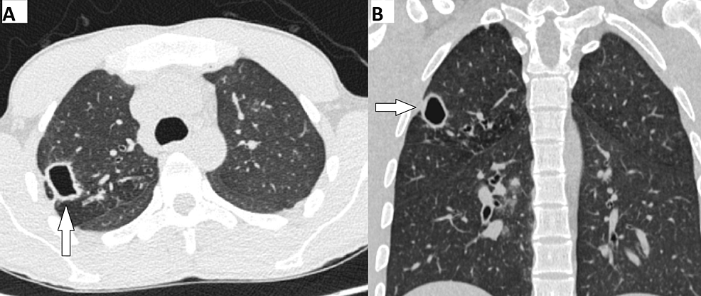 Cureus | Role of Multidetector Computed Tomography in Differentiation ...