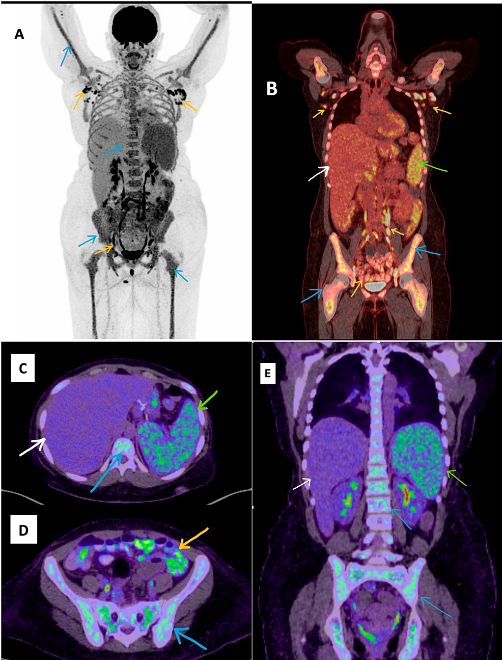 A Challenging Case of Adult-Onset Still's Disease Complicated by ...
