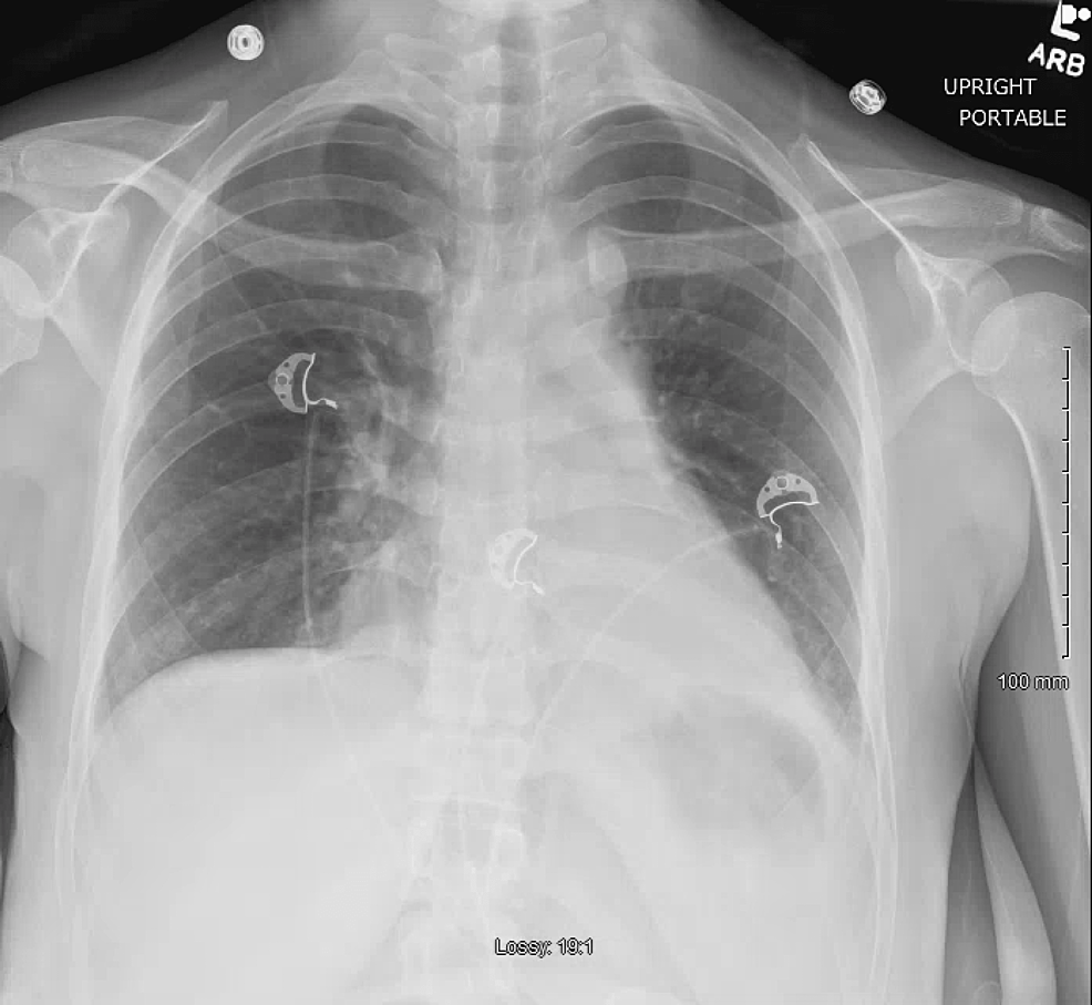 Acute Respiratory Distress Syndrome: A Rare Manifestation of Rhinovirus ...