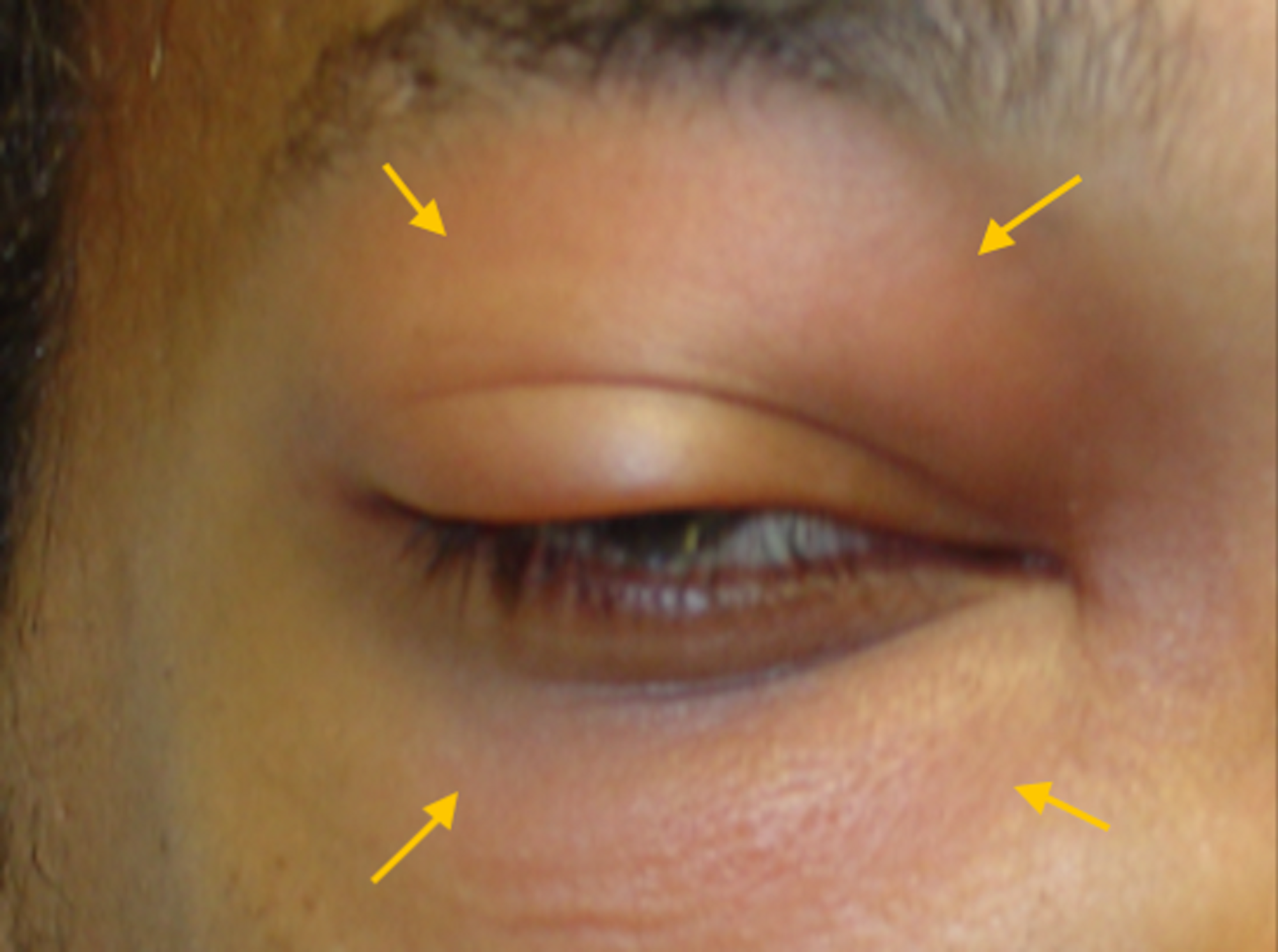 Cureus Preseptal And Postseptal Orbital Cellulitis Of Odontogenic Origin