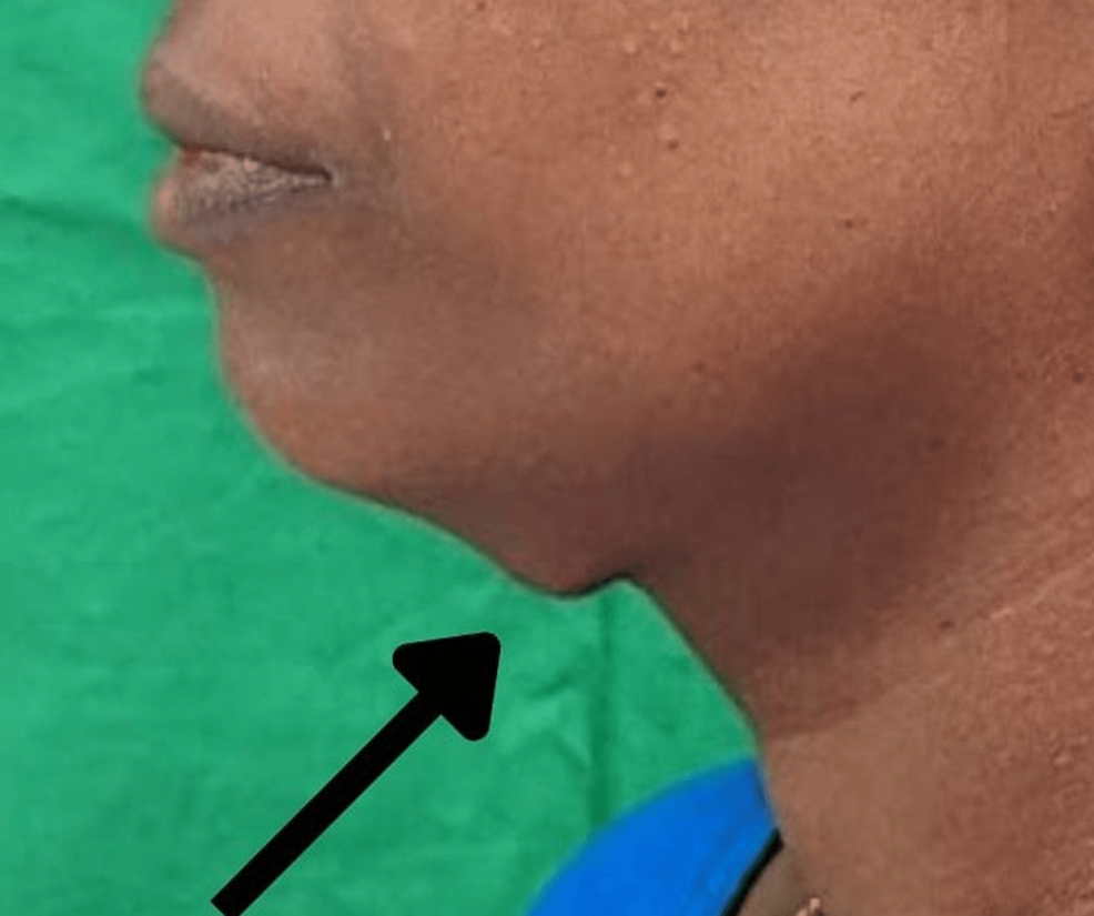 Cureus Hemangioma Of Tongue With Multiple Phleboliths Involving Cureus Hemangioma Of Tongue With Multiple Phleboliths Involving