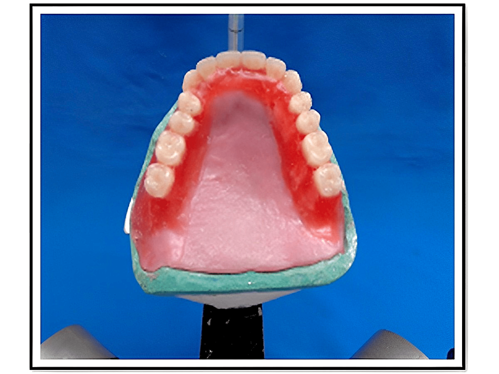A Technique for Obtaining Balanced and Functional Occlusion Through ...