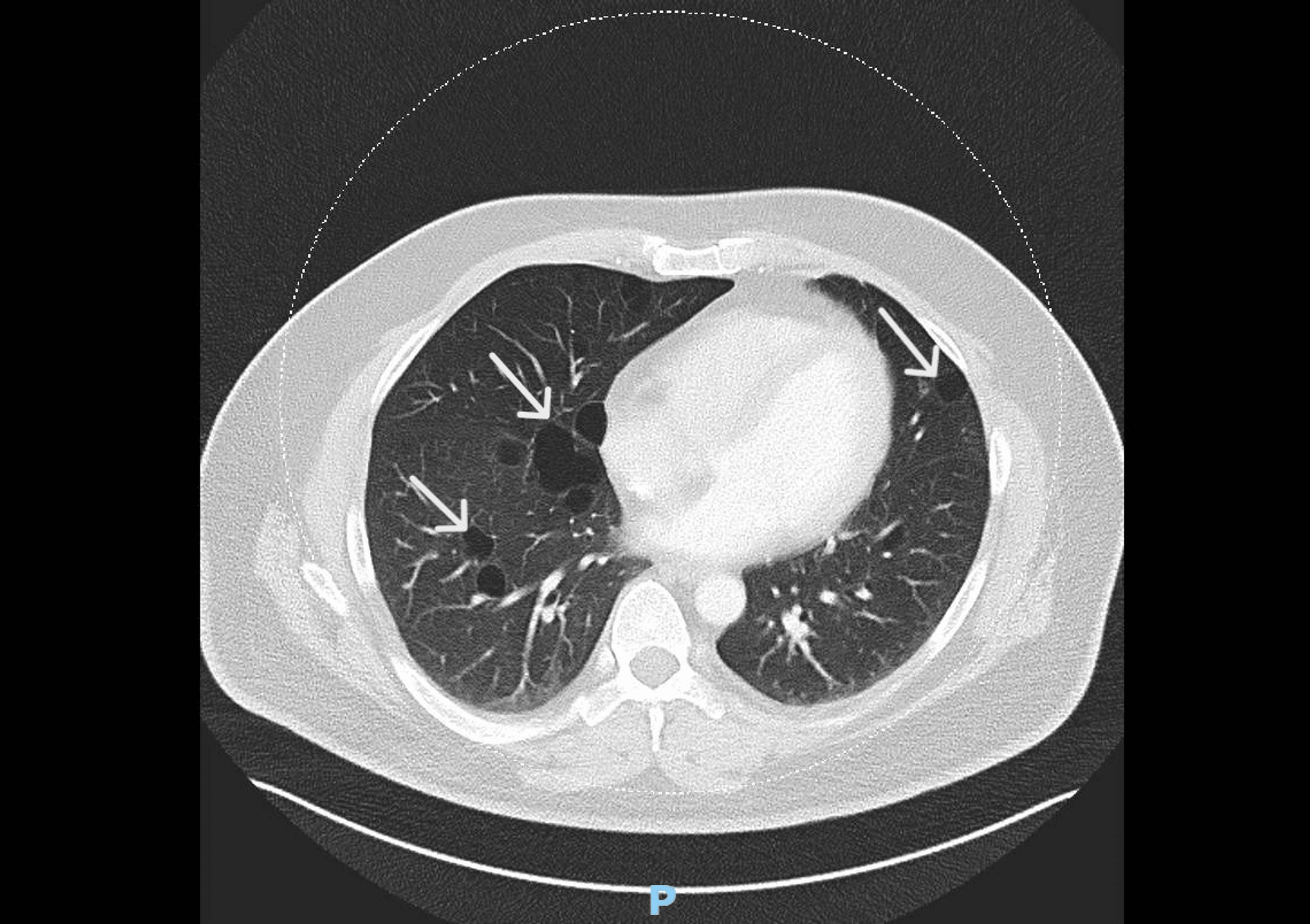 Renal Cell Tumor and Cystic Lung Disease: A Genetic Link for ...