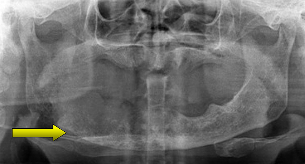 cureus-metastatic-tumour-to-the-mandible-a-diagnostic-and