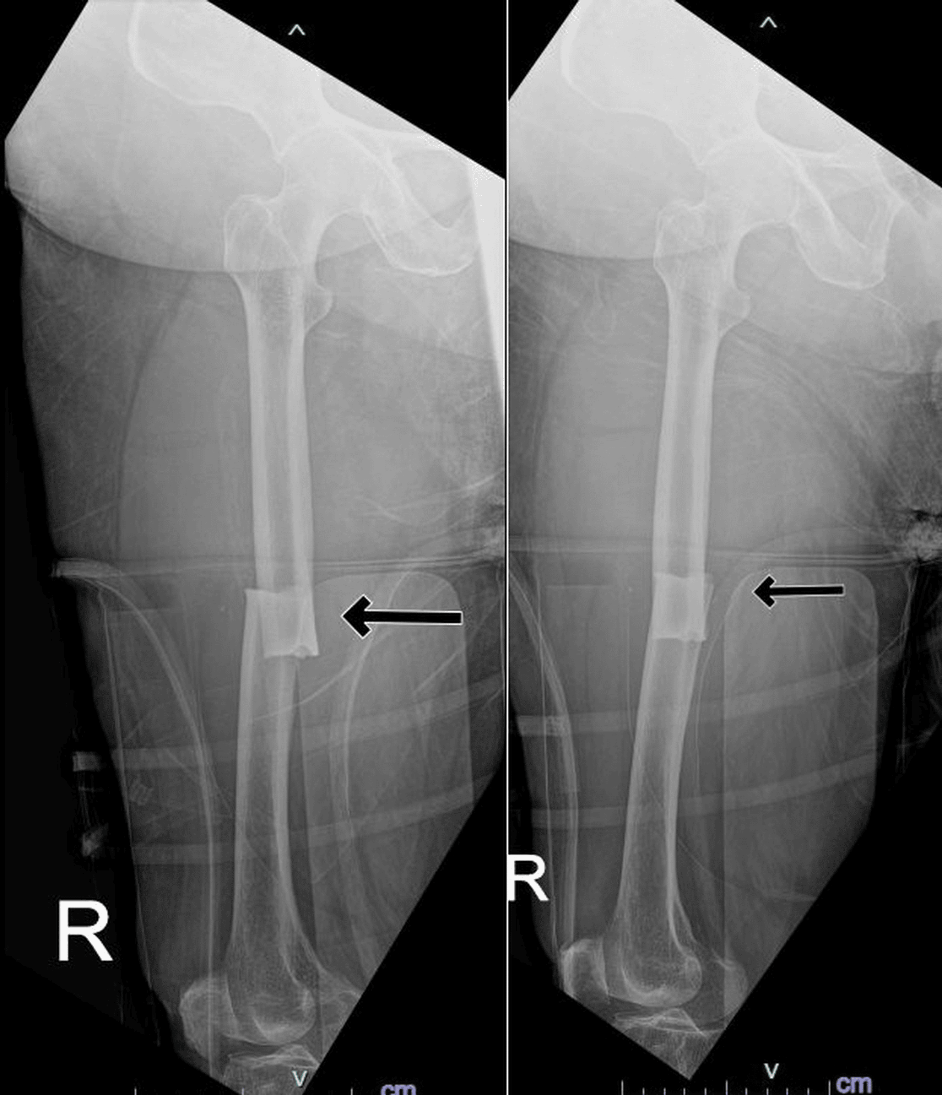 Cureus A Rare Case Of Obliterated Femoral Canal In Atypical Femoral
