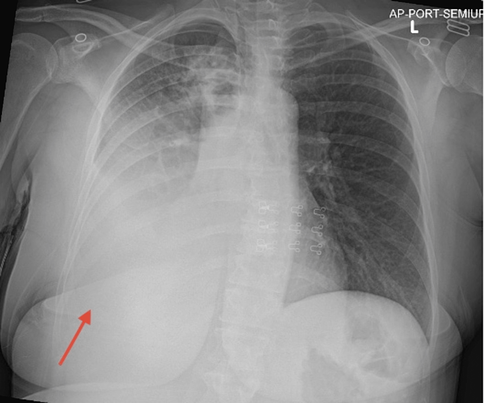 Cureus | Veillonella Intrapulmonary Abscess With Empyema