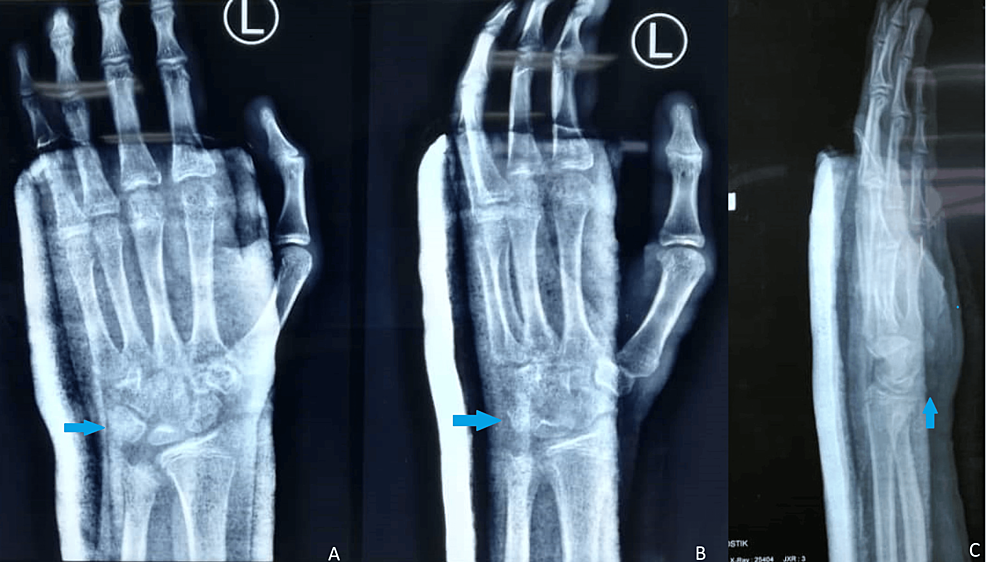 Atraumatic Isolated Dislocation of Pisiform With Ulnar Nerve Palsy | Cureus