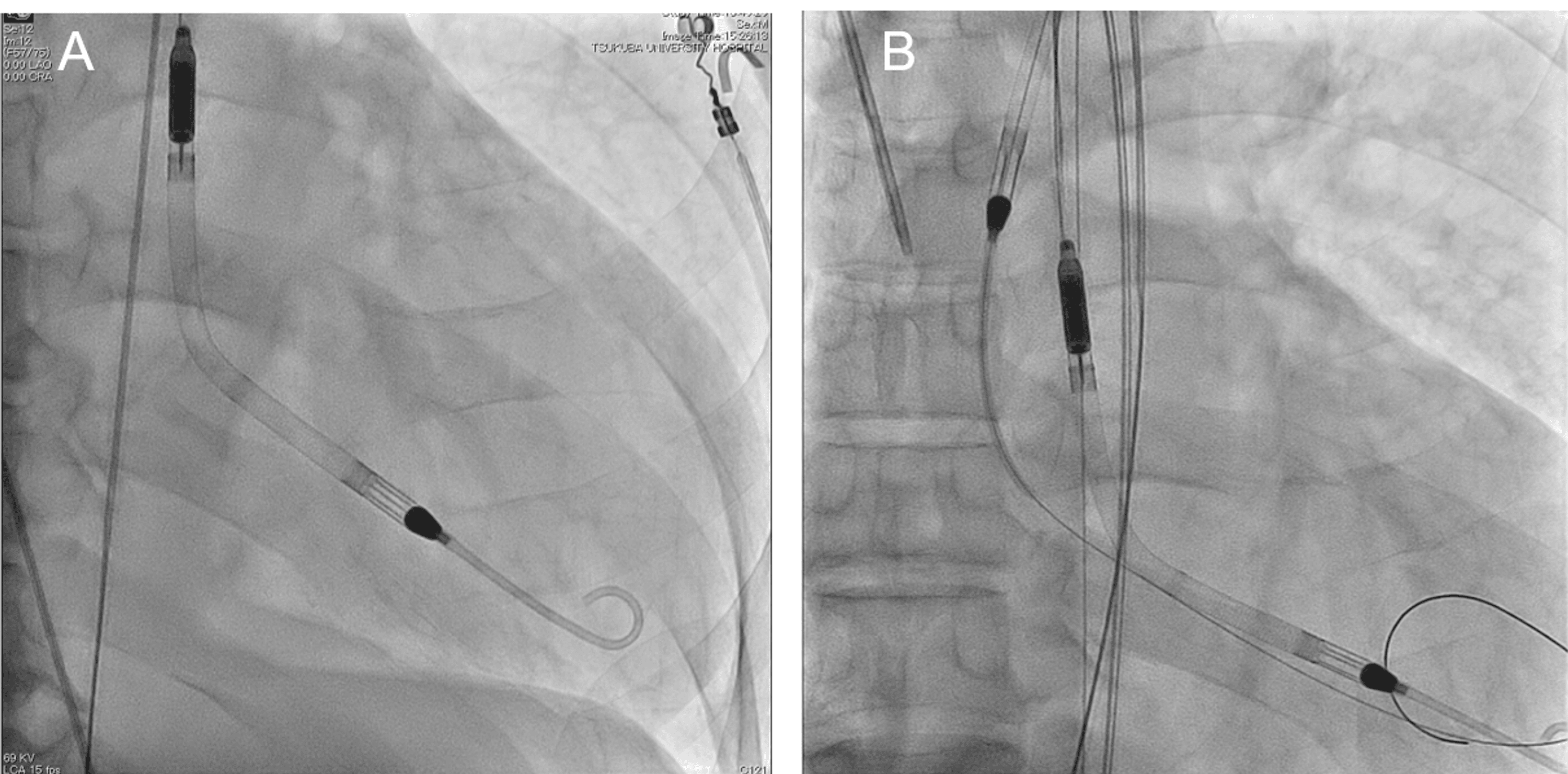 Cureus | Comprehensive Unloading Strategy for Rapid Heart Recovery ...