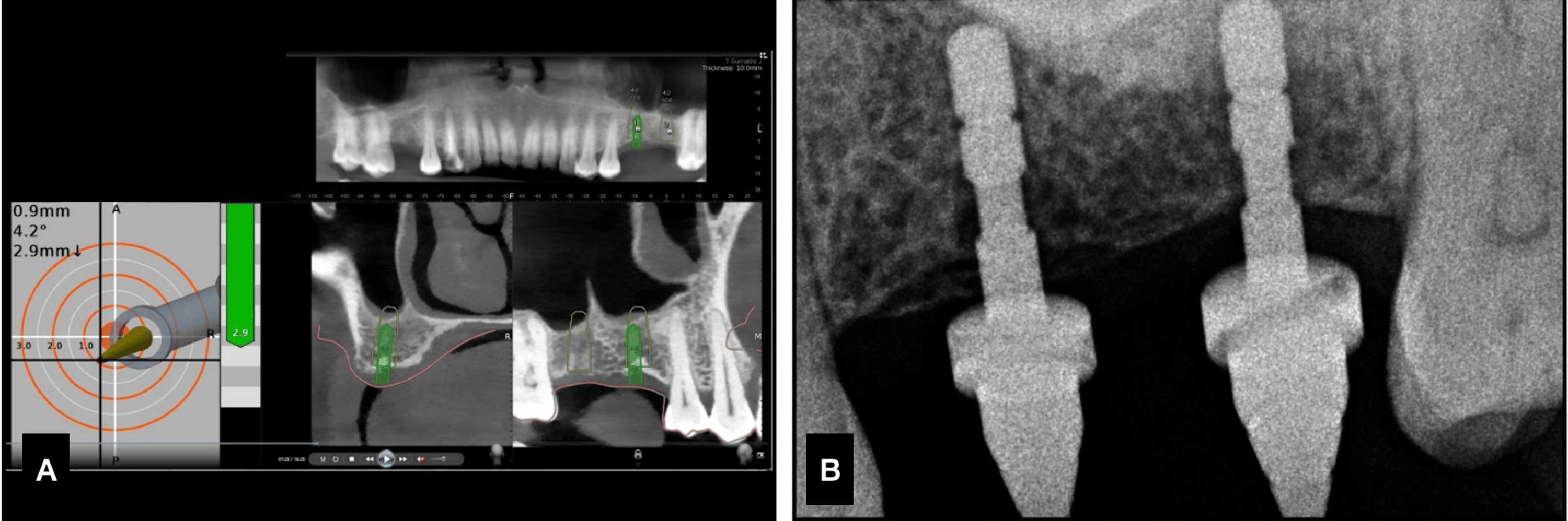 Hybrid Navigation Technique for Improved Precision in Implantology | Cureus