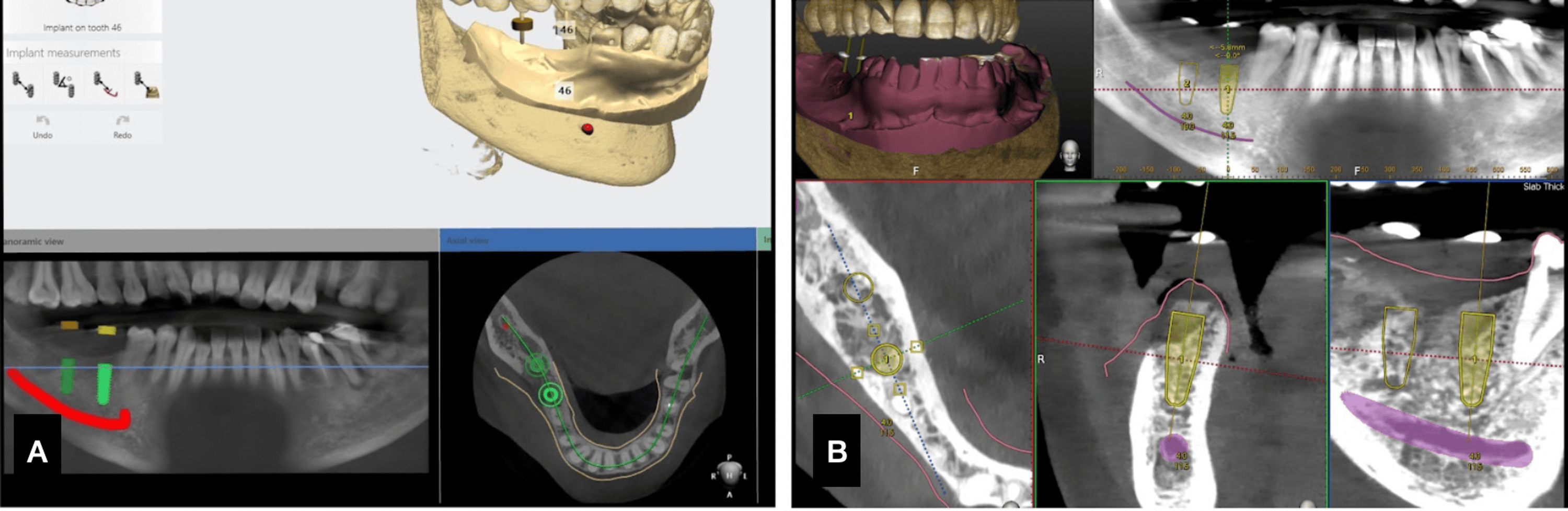 Hybrid Navigation Technique for Improved Precision in Implantology | Cureus