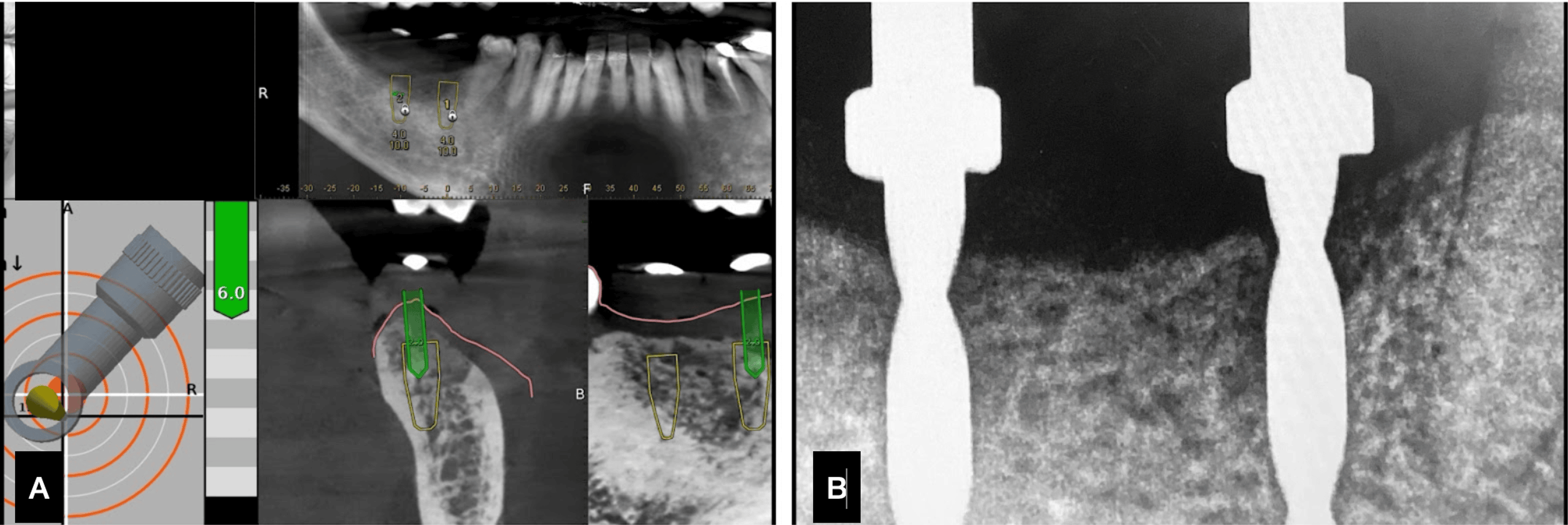 Hybrid Navigation Technique for Improved Precision in Implantology | Cureus