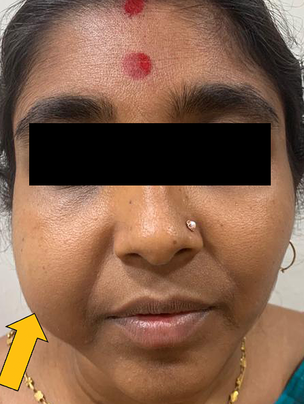 Cureus Pleomorphic Adenoma Of The Cheek A Case Report
