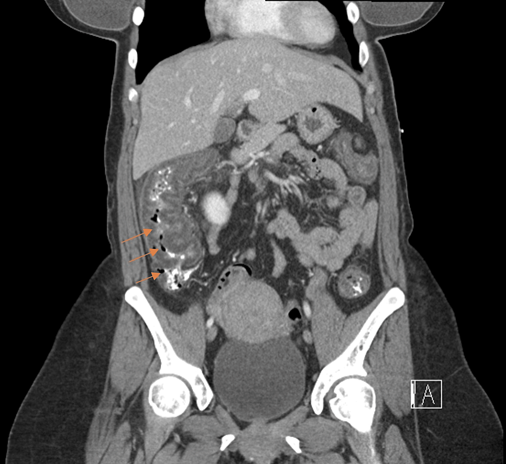 Ischemic Colitis in a Young Female Following Herbal Supplement ...