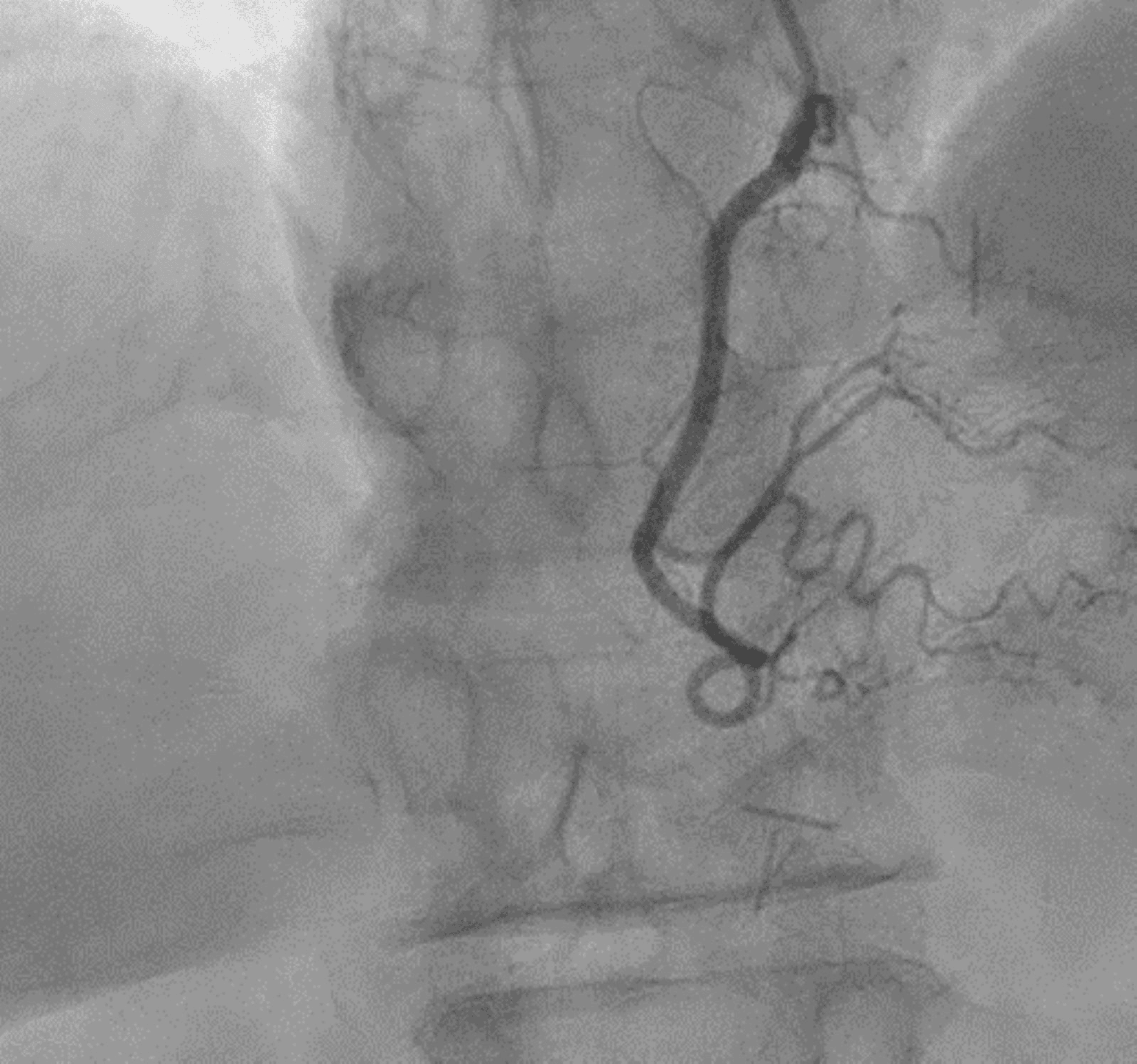 False Elevation of Troponin Levels in a Patient With Chest Pain and ...