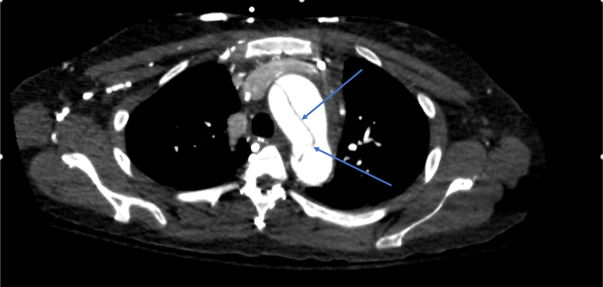 Aortic Dissection Ct Scan