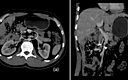 Diagnostic Challenges in Adult Intestinal Malrotation: A Case Report ...