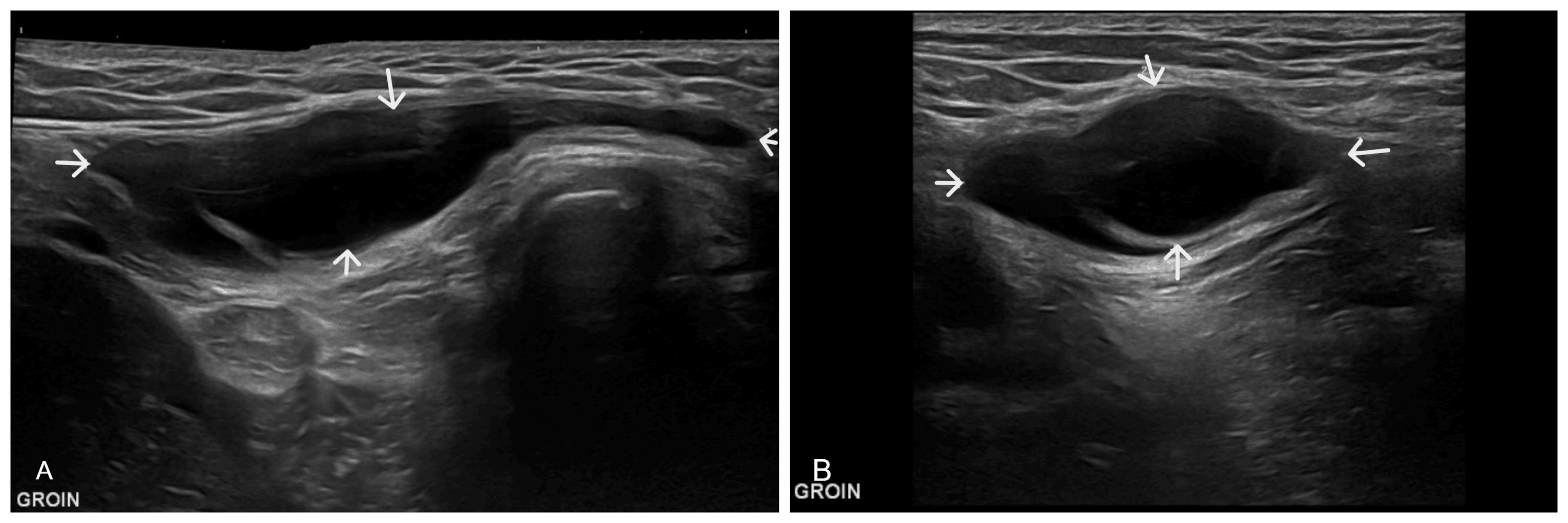 A Case Report of Female Hydrocele of the Canal of Nuck (Type I): A ...