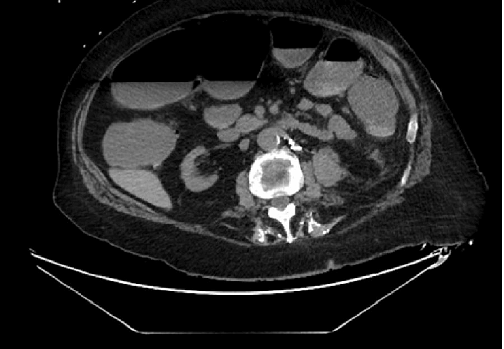 Cureus Recurrent Left Renal Fossa Clear Cell Renal Cell Carcinoma