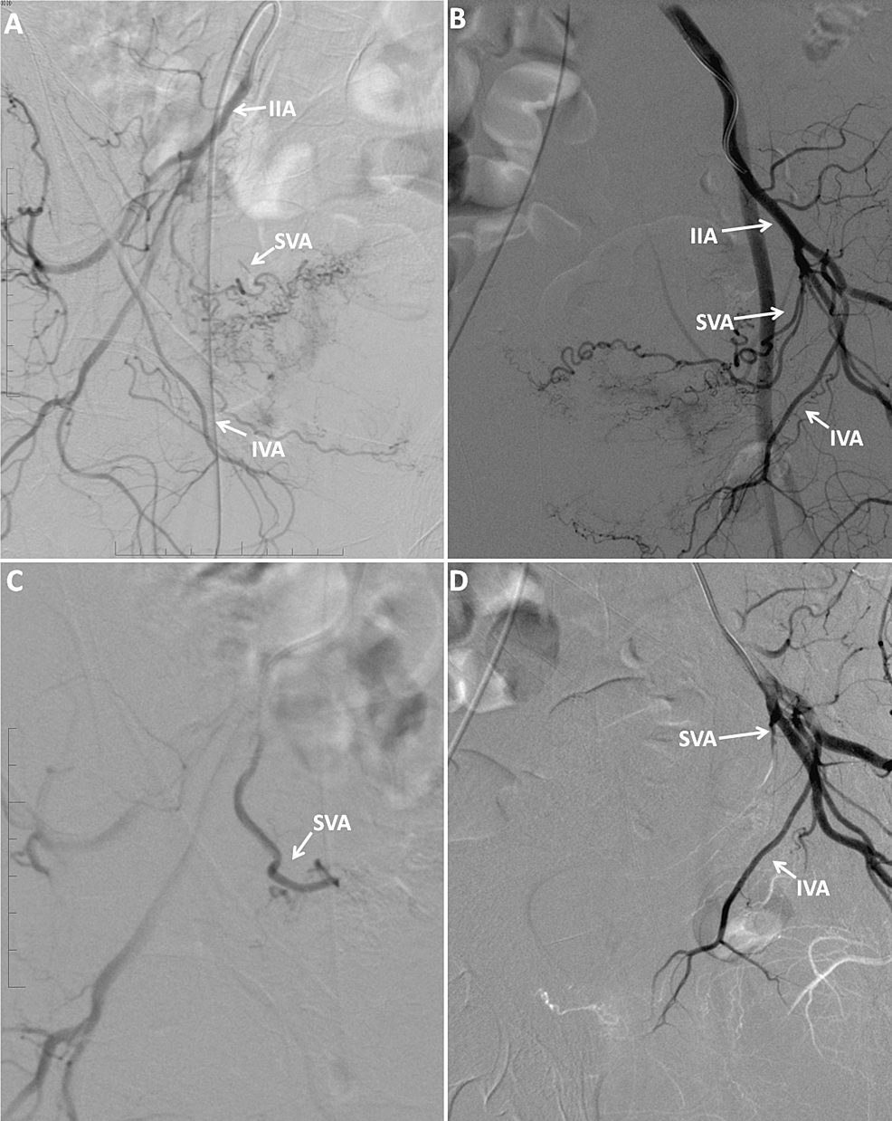 Super-Selective Trans-Catheter Arterial Embolization (TAE) of the ...