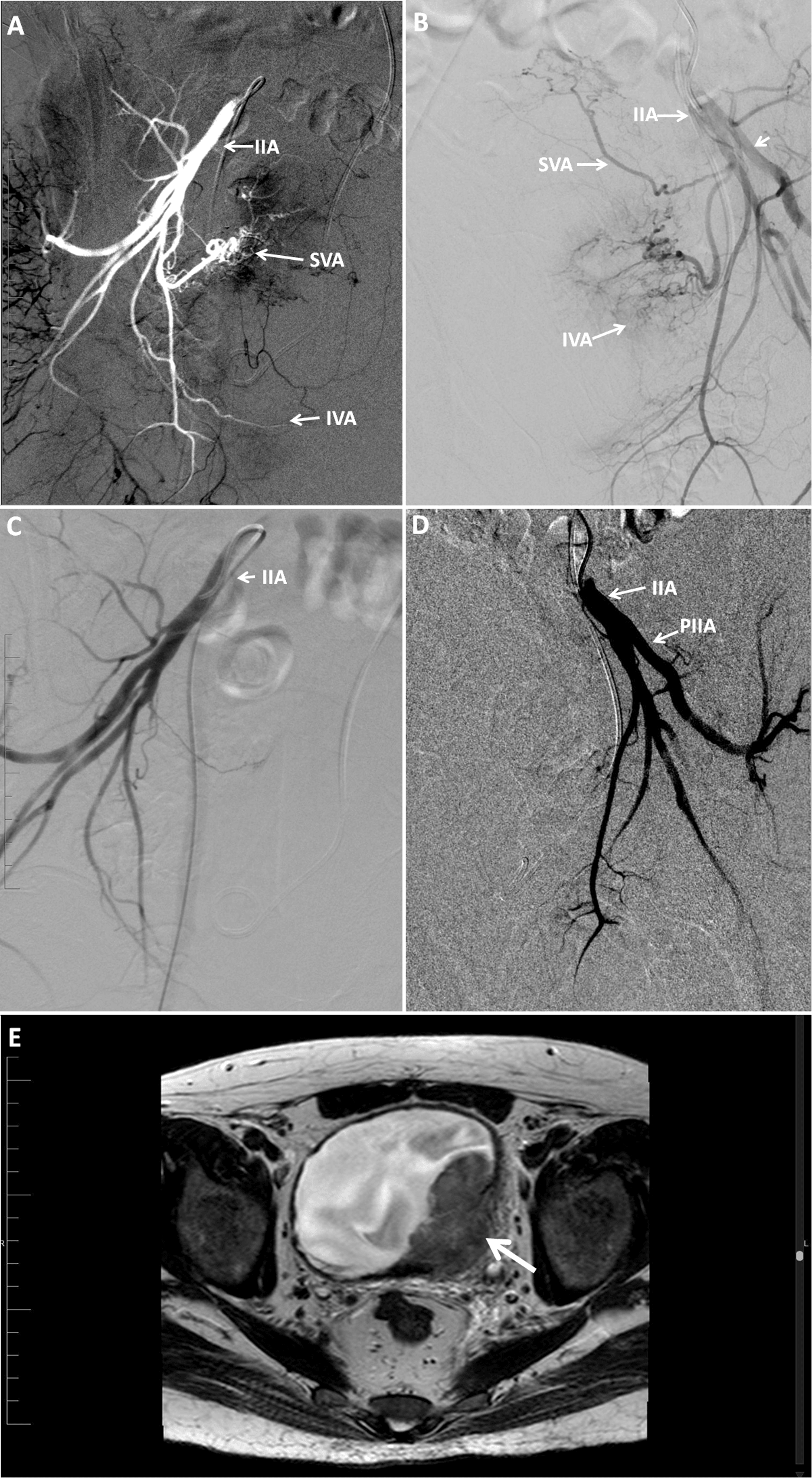 Super-Selective Trans-Catheter Arterial Embolization (TAE) of the ...