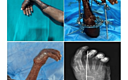 Management of Patients With Post-Traumatic Wrist Flexor Contracture by ...
