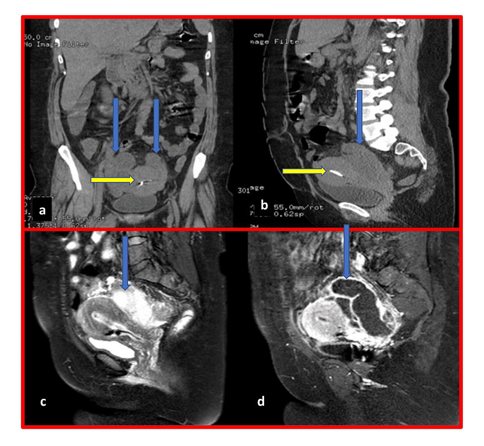Cureus | Bilateral Pyosalpinx Due to a 16-Year-Old Intrauterine Device ...