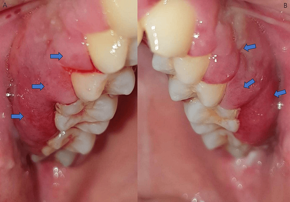 Cureus | Gingival Enlargement Can Constitute the Only Diagnostic Sign ...