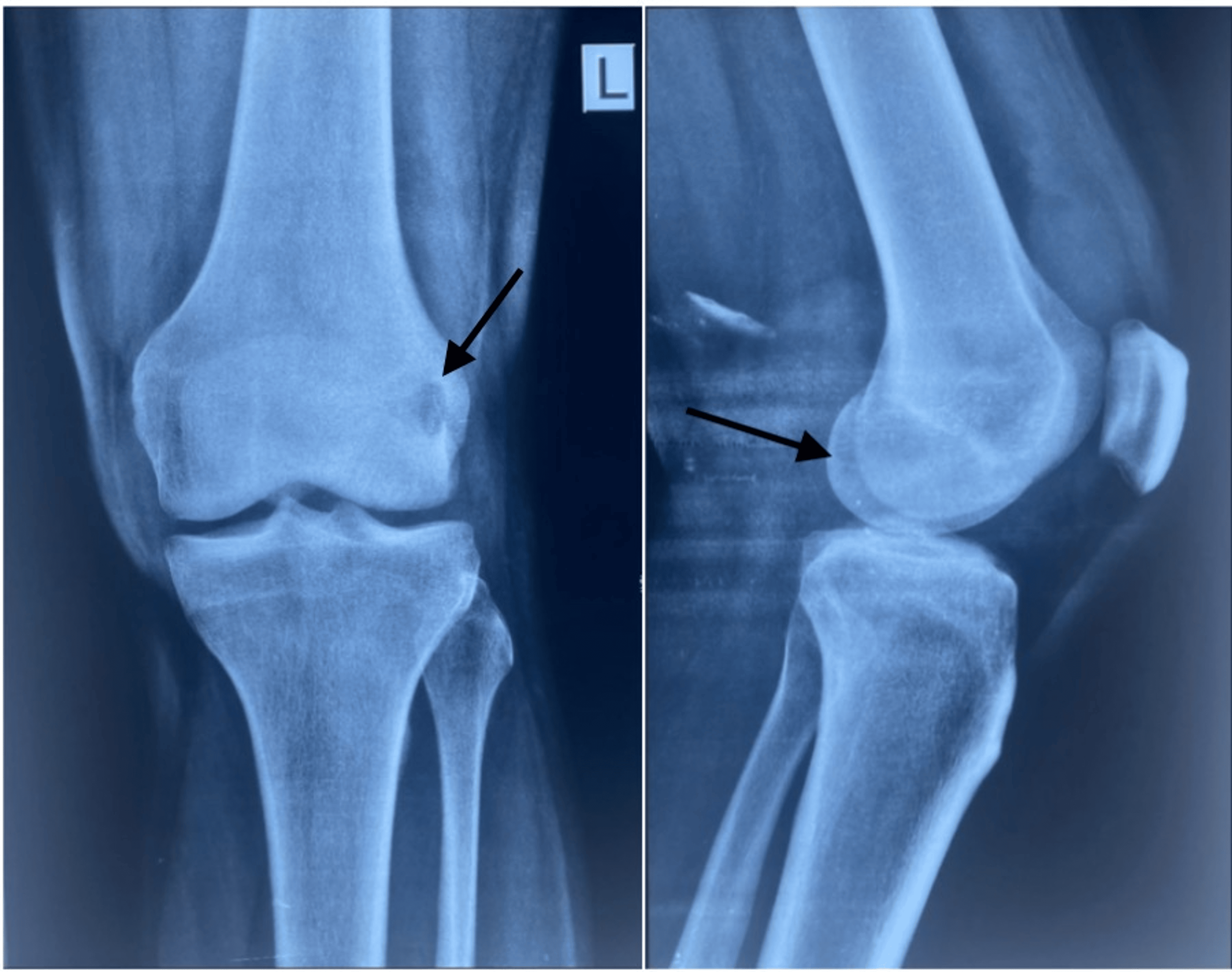 Tuberculosis of the Lateral Condyle of the Femur: A Case Report | Cureus