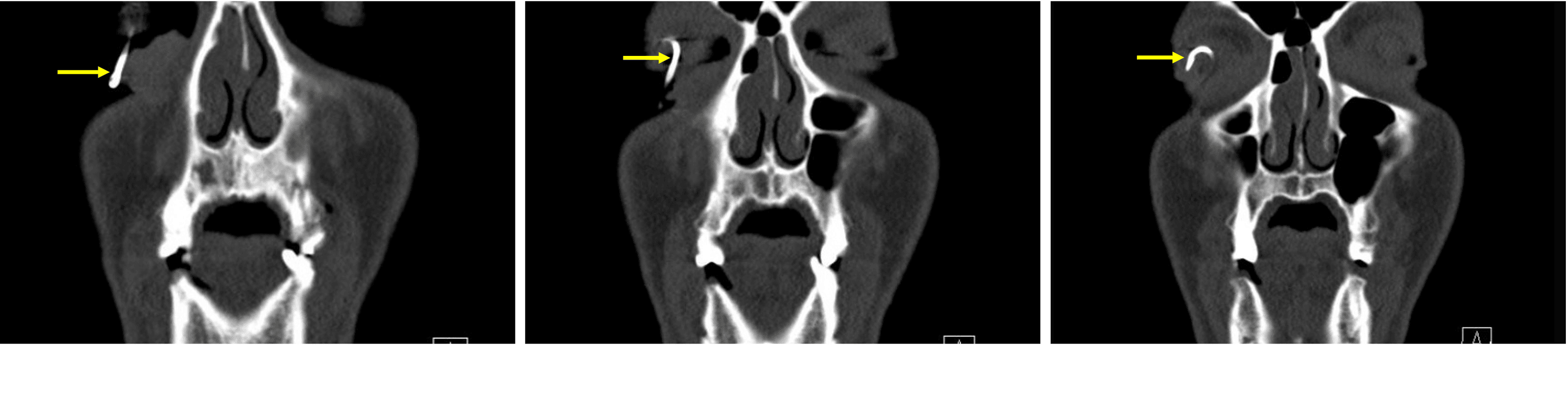 Penetrating Ocular Fish-Hook Injury | Cureus