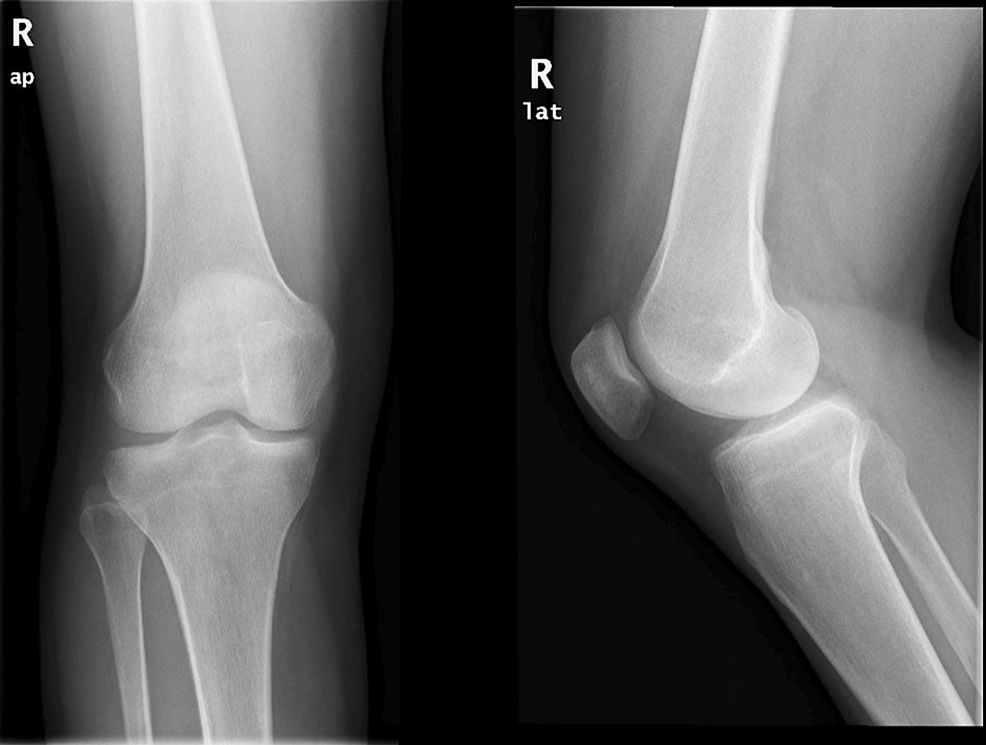 Missed Diagnosis of a Rare Retropatellar Juxta-Articular Angioleiomyoma ...