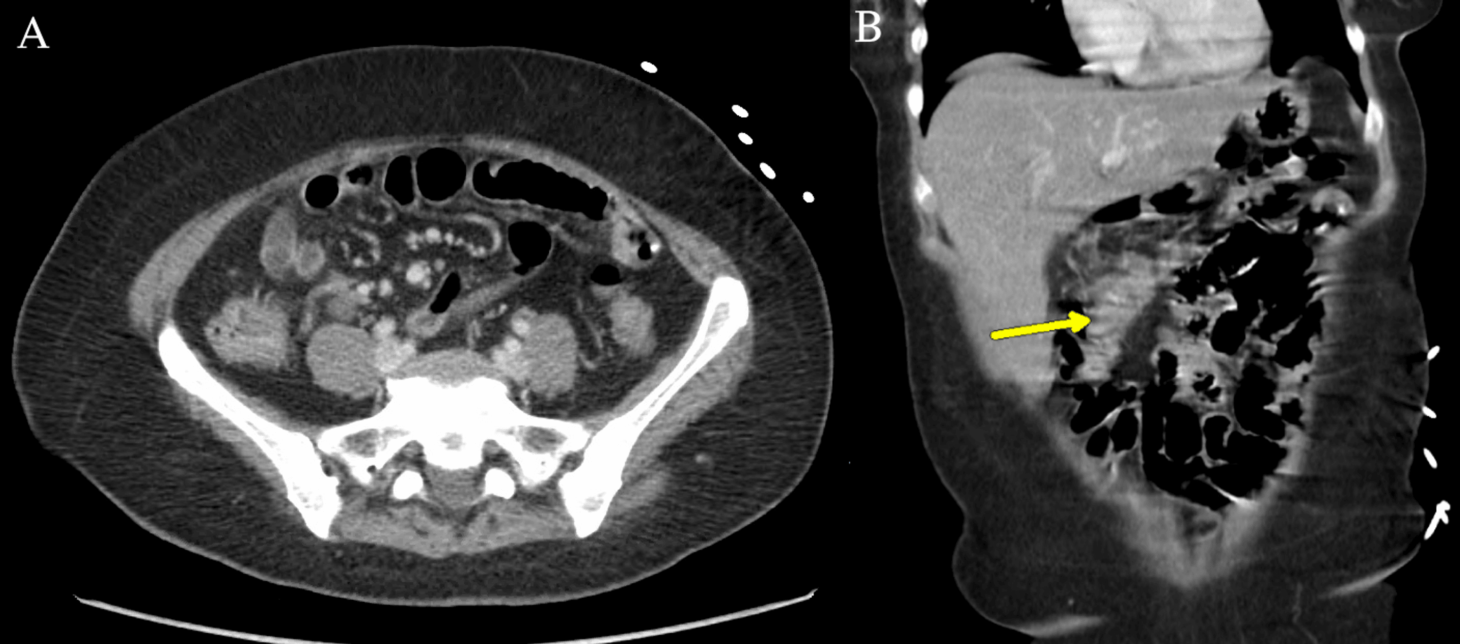 Cureus | An Unusual Discovery of Multi-Opportunistic Organisms in ...