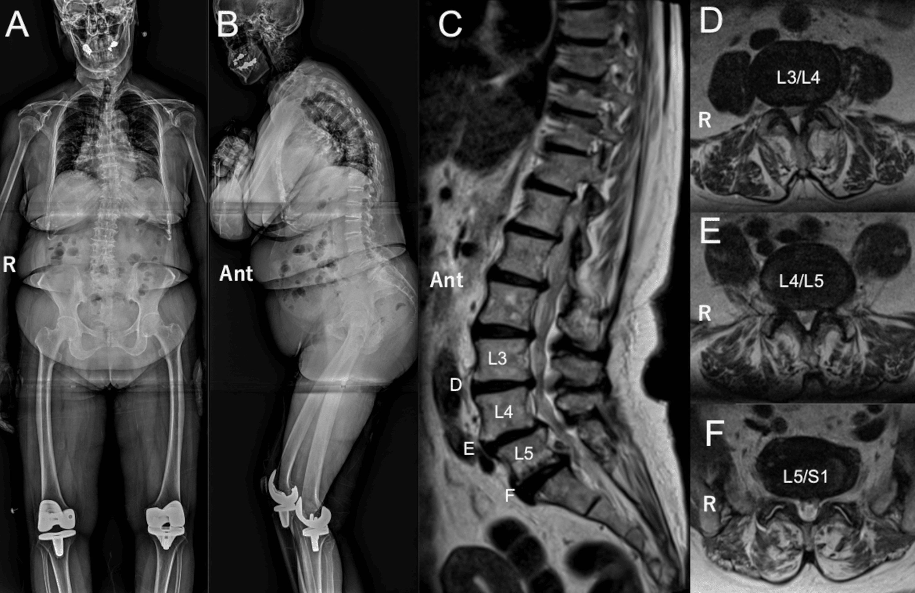 Vertebral Fracture In A Short Period Following Posterior Decompression