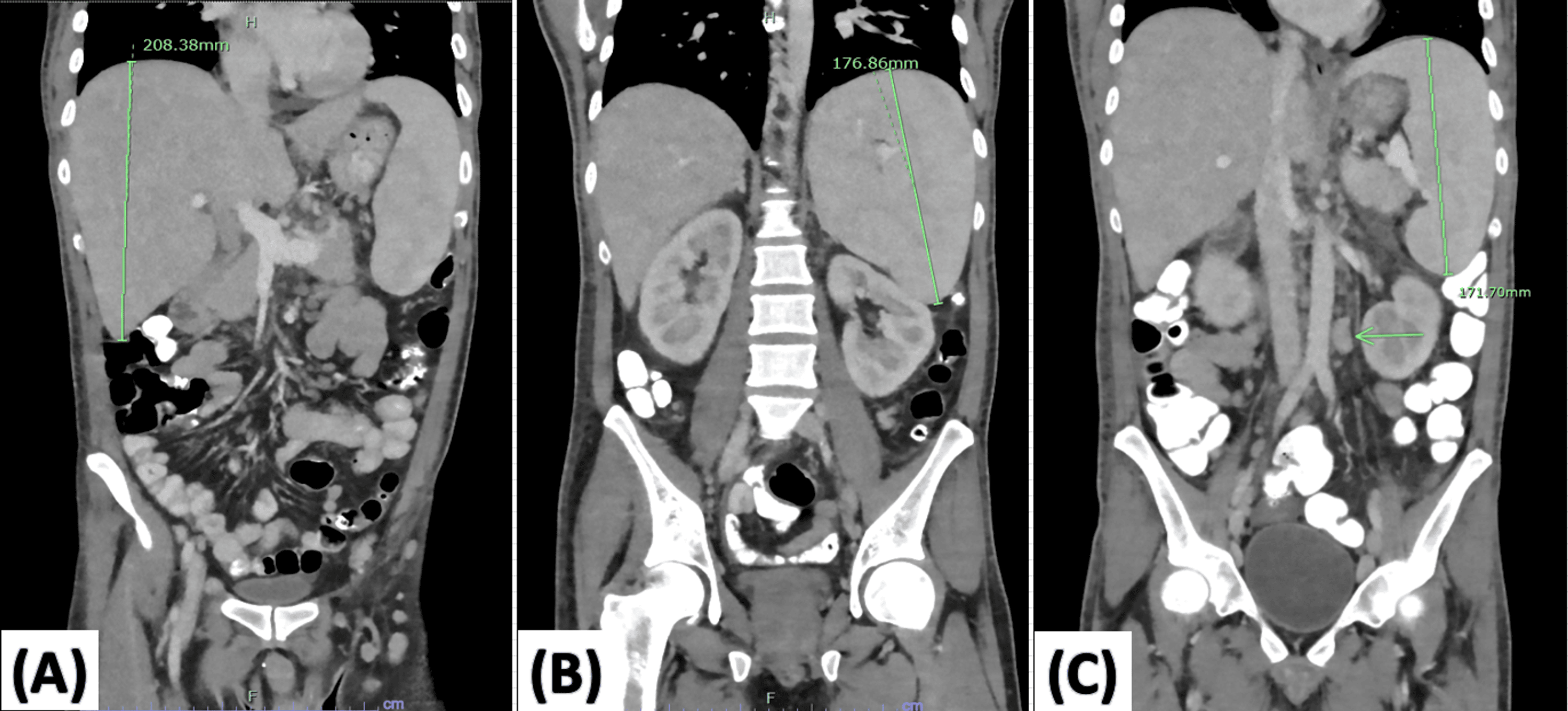 Atypical Adult-Onset Still’s Disease Presenting With Seizures and ...