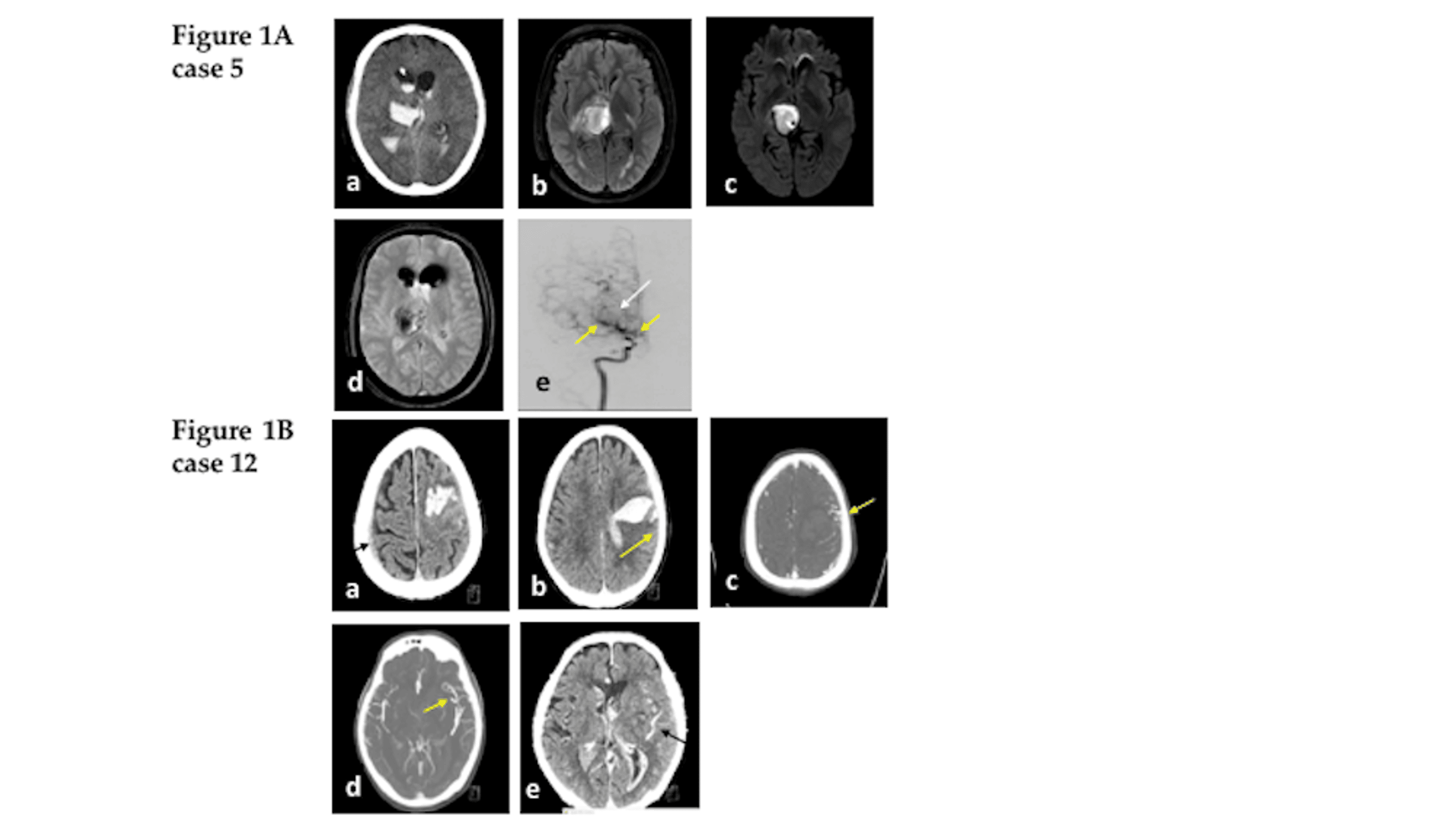 Spontaneous Intracranial Hemorrhages in a Community of Asian Americans ...