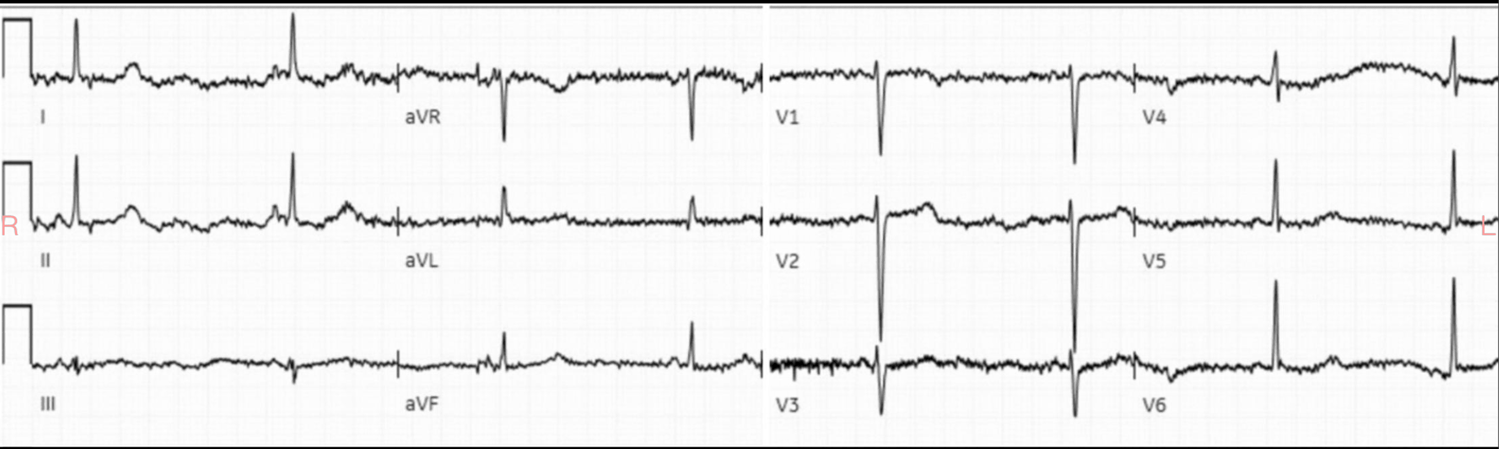 Cureus Benzodiazepine And Zolpidem Induced Bradycardia A Case Report