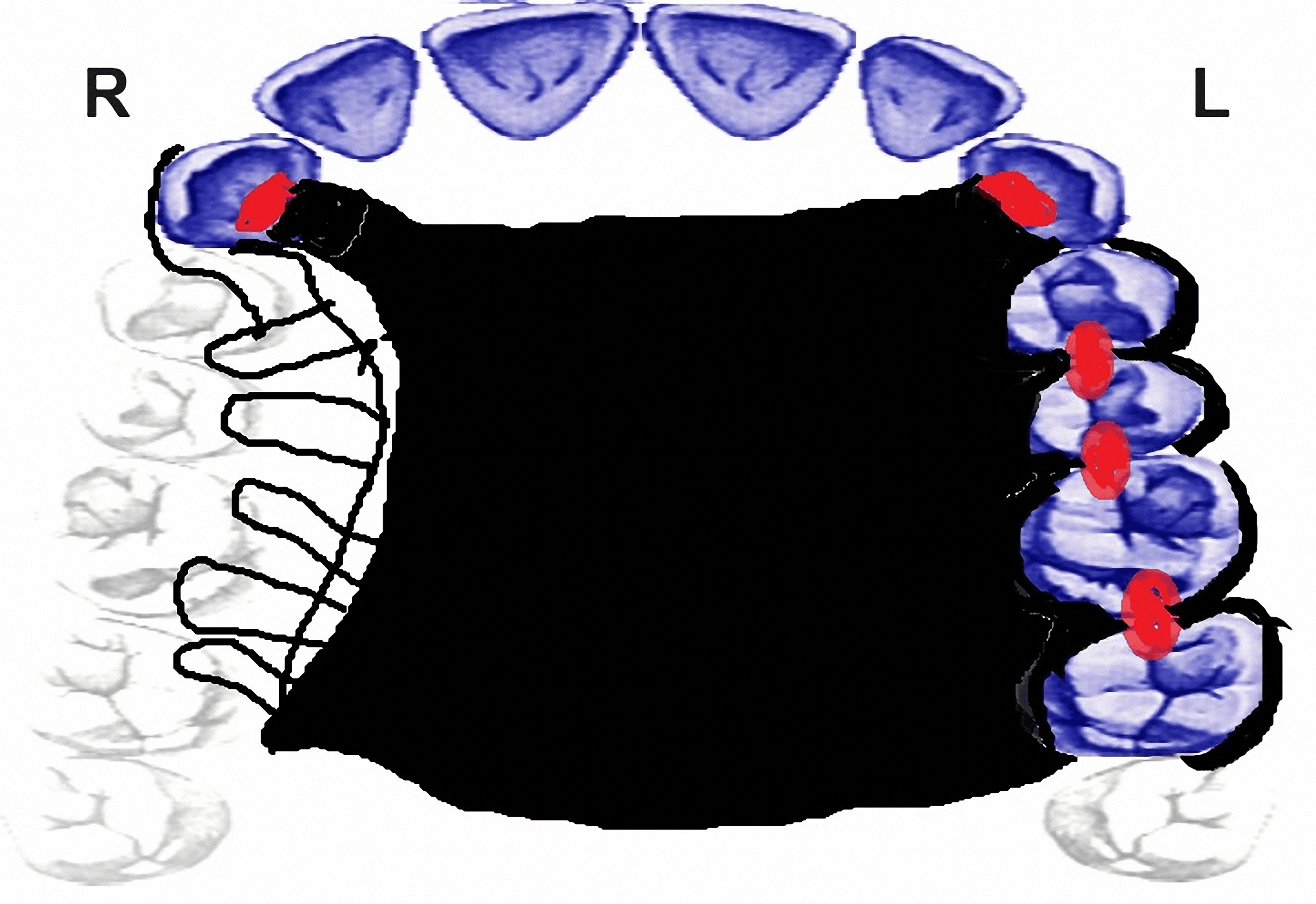 Fabrication of a Definitive Obturator for a Patient With a Maxillary ...