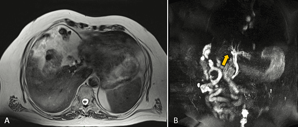 Gallbladder Agenesis: Must General Surgeons Have It on Their Diagnostic ...