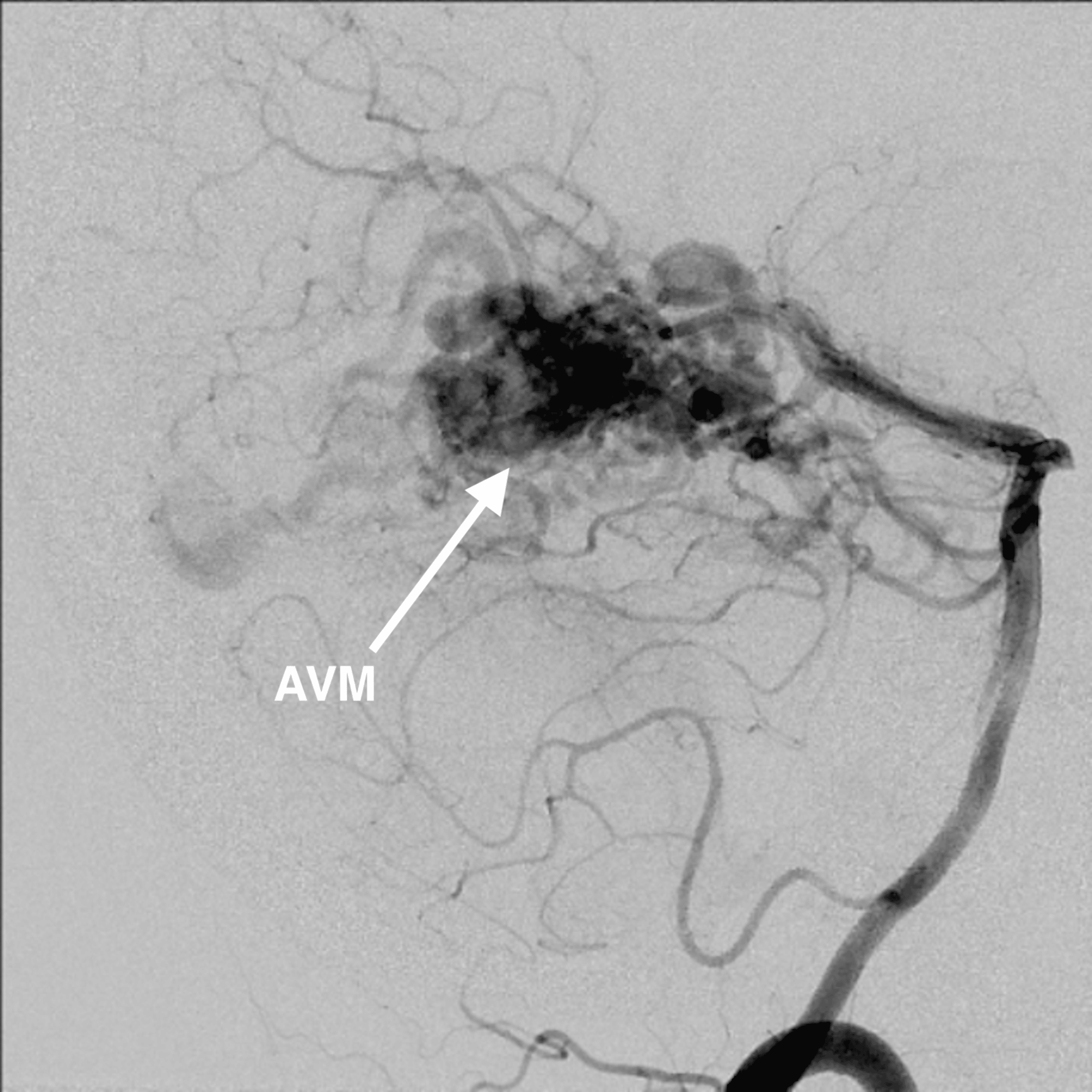 Cureus | Efficacy of Dose-Escalated Hypofractionated Radiosurgery for ...