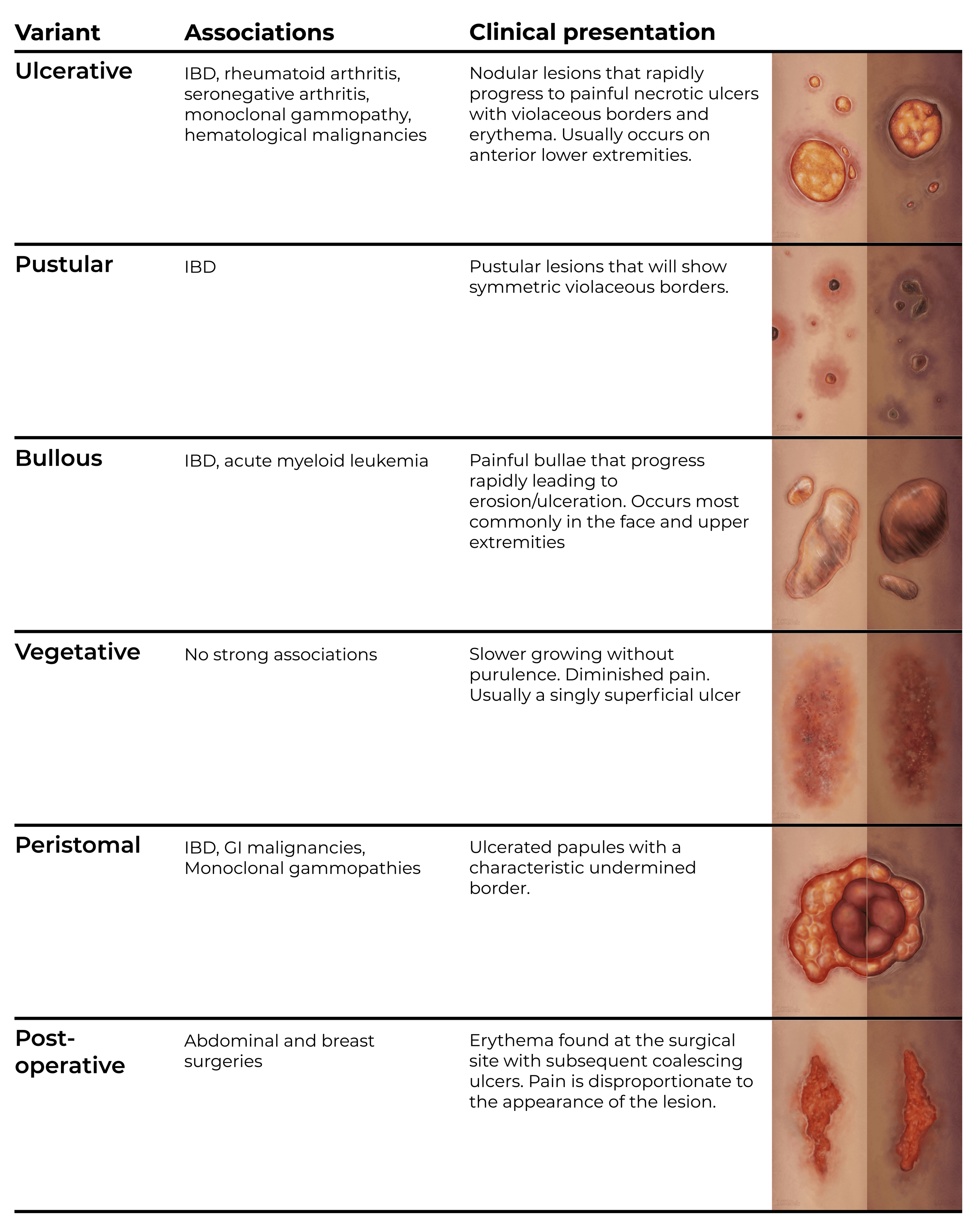 Narrative Review: Pyoderma Gangrenosum | Cureus