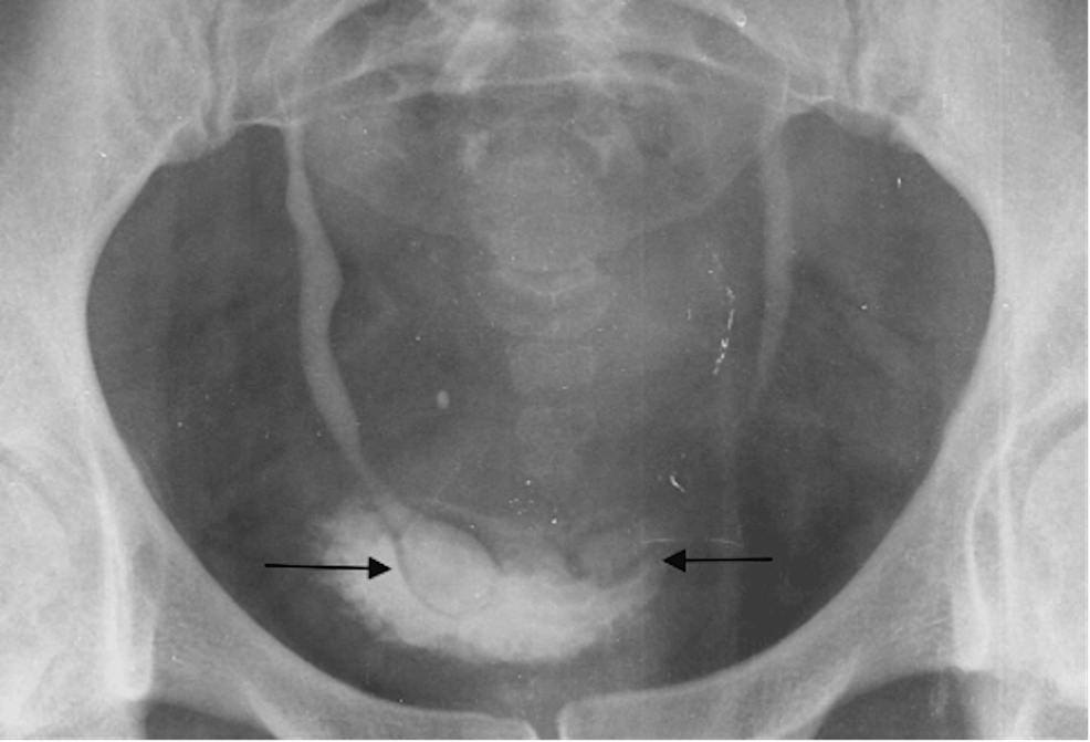The Radiographic Appearances of Bilateral Ureteroceles and Their ...