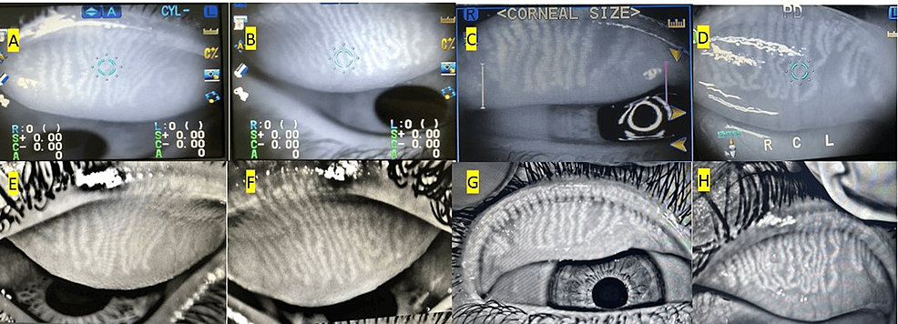 The Use of Infrared Auto Refractometer for Meibomian Gland Imaging | Cureus