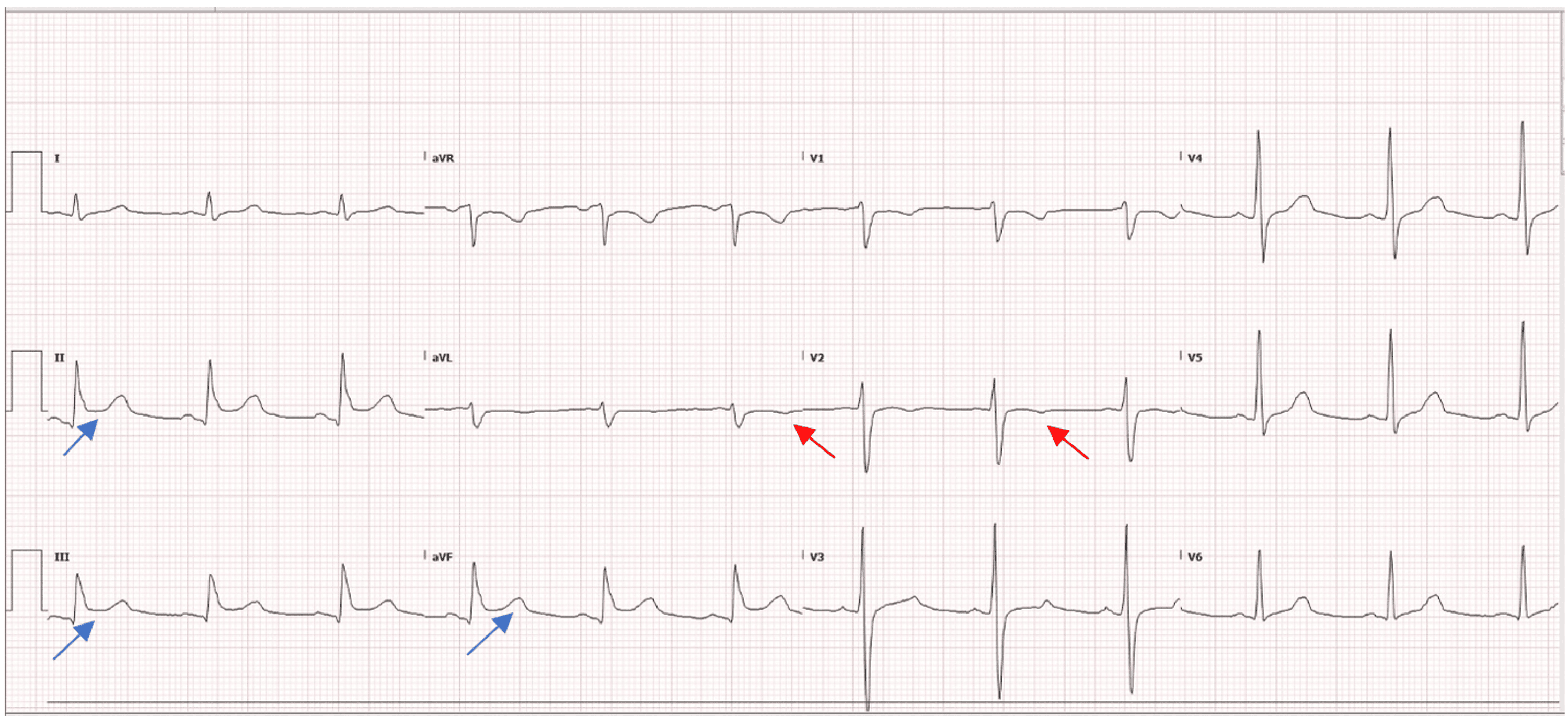 Traumatic Brain Injury With Concomitant Myocardial Infarction: A ...